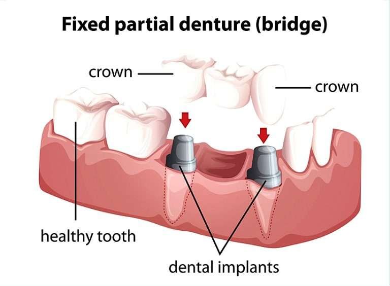 Fixed Crown & Bridges – Dental Clinic Punjab